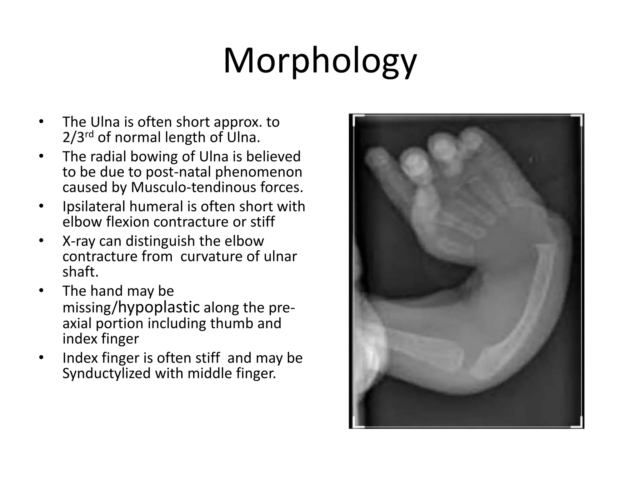Radial Deficiency and Management.pptx