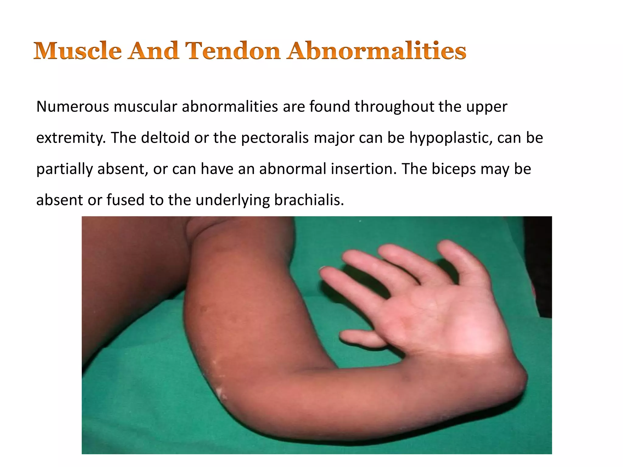 Radial Dysplasia By Kids Orthopedic | PPT