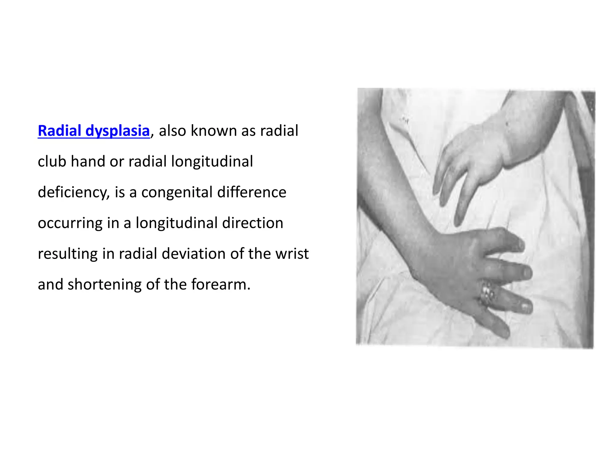 Radial Dysplasia By Kids Orthopedic | PPT