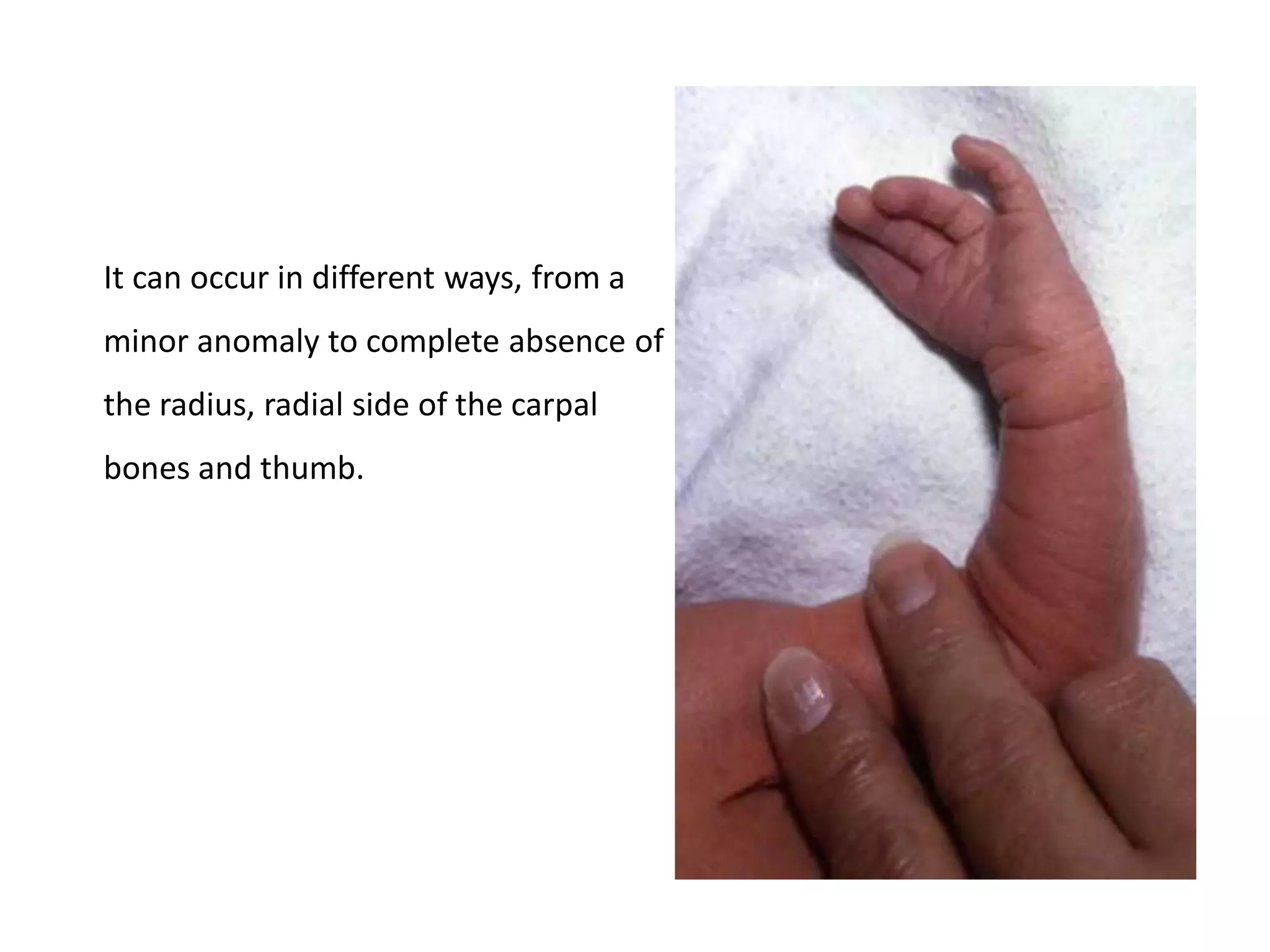 Radial Dysplasia By Kids Orthopedic | PPT