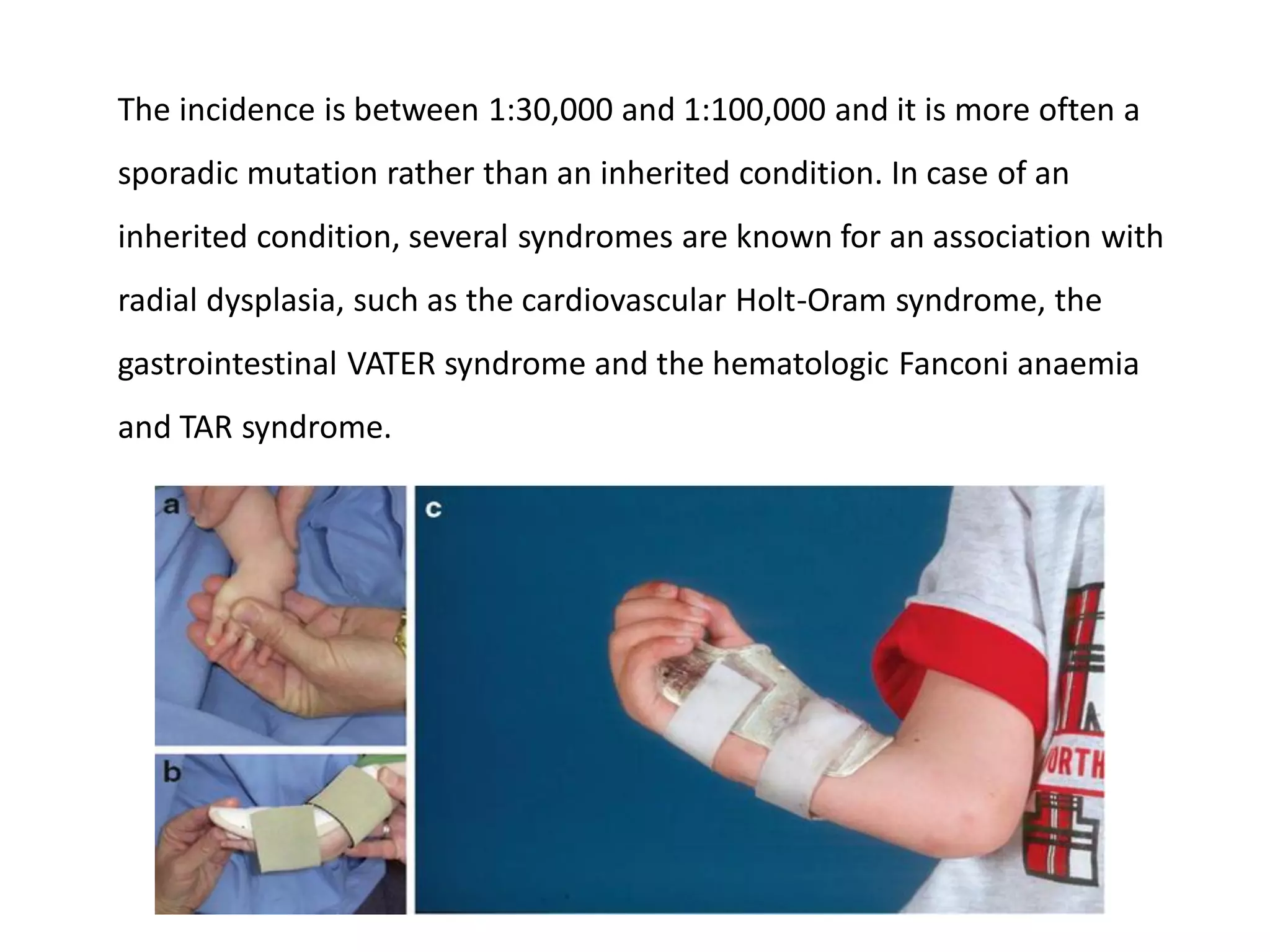 Radial Dysplasia By Kids Orthopedic | PPT
