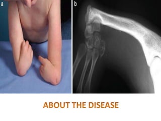 Radial Dysplasia By Kids Orthopedic | PPT