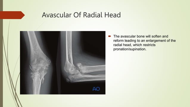 Radial Head Excision technique Operation .pptx | First Aid | Injuries