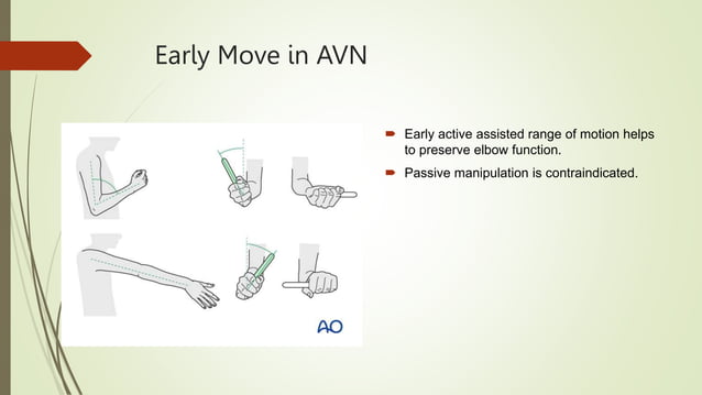 Radial Head Excision technique Operation .pptx | First Aid | Injuries