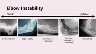 Powerpoint presentation on Radial Head and Neck Fractures | PPTX