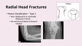 Radial Head and Neck Fractures powerpoint | PPTX