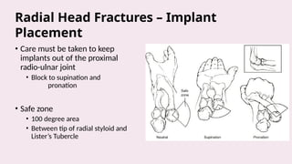 Radial Head and Neck Fractures powerpoint | PPTX