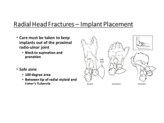 RADIAL HEAD AND NECK FRACTURE IN EMERGENCY | PPTX