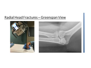 RADIAL HEAD AND NECK FRACTURE IN EMERGENCY | PPTX