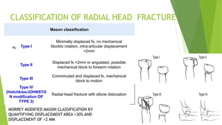 Radial head fracture | PPTX