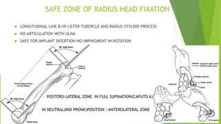 Radial head fracture | PPTX
