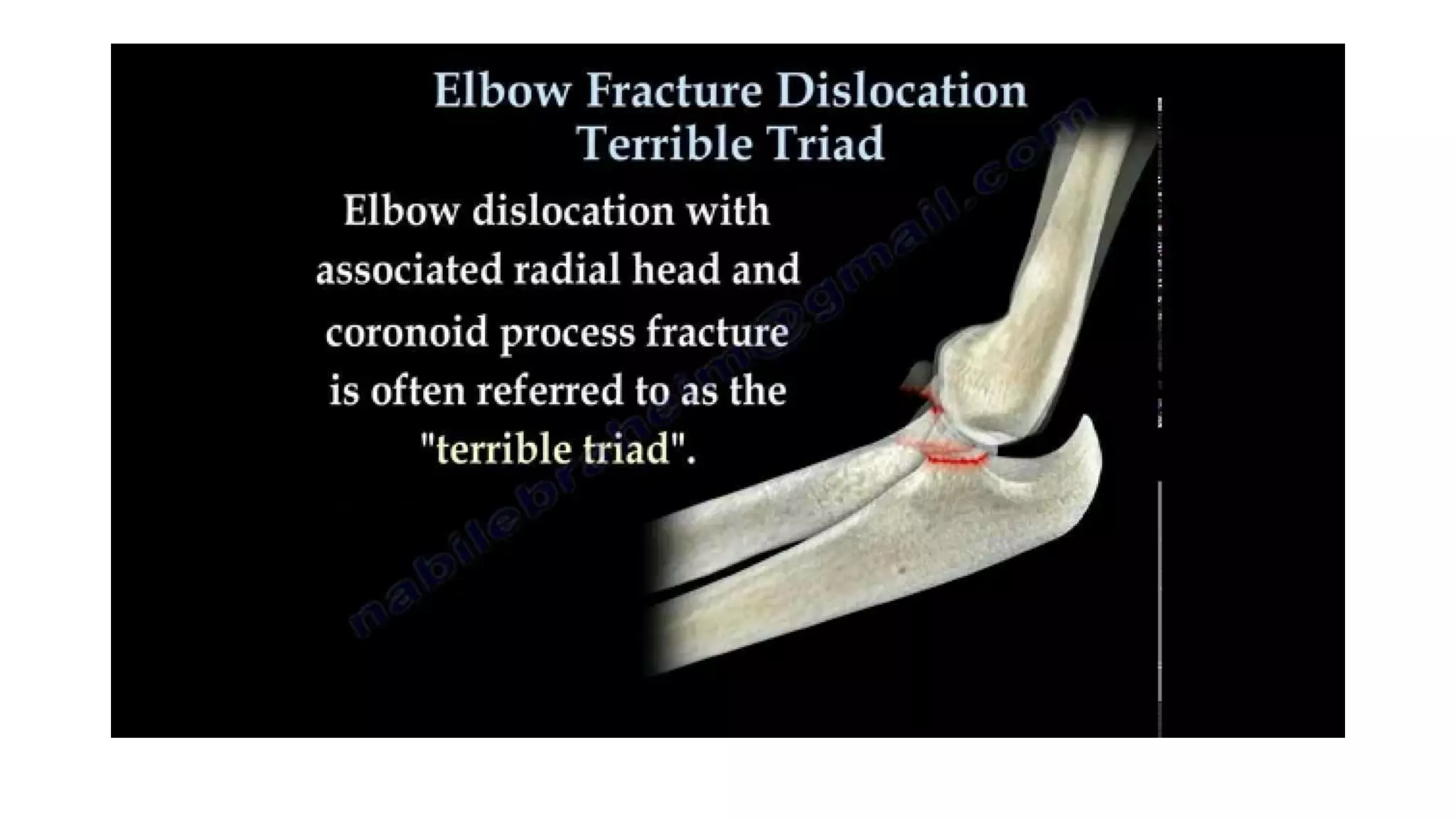 Radial head fracture | PPTX