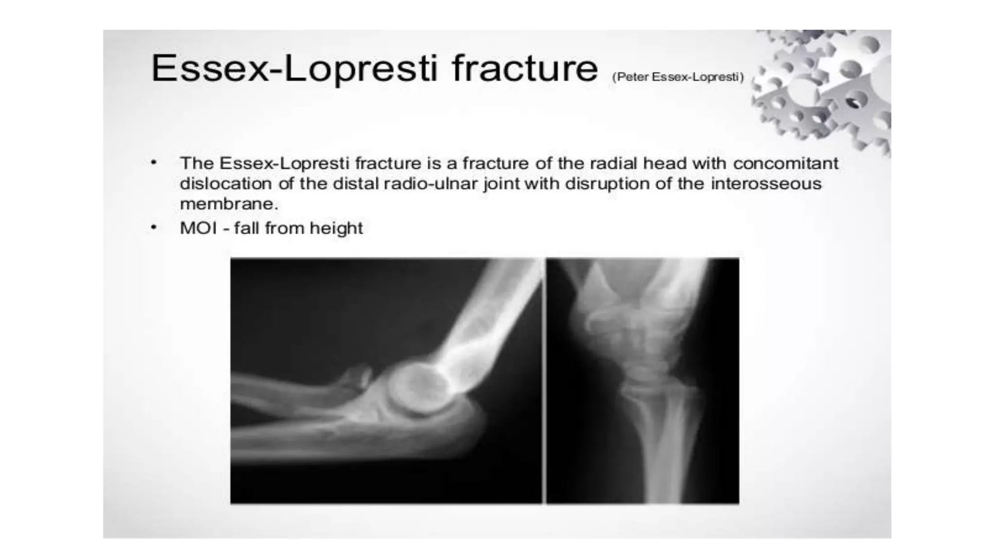 Radial Head Fracture Pptx
