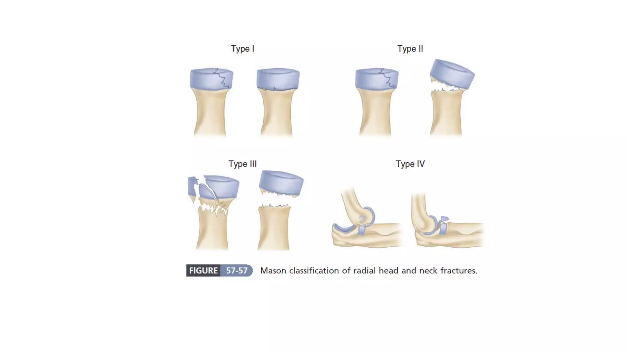 Radial head fracture | PPTX