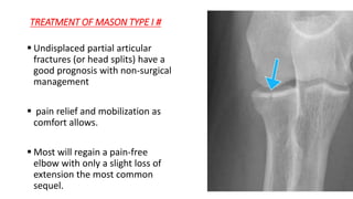 Radial head fracture | PPTX