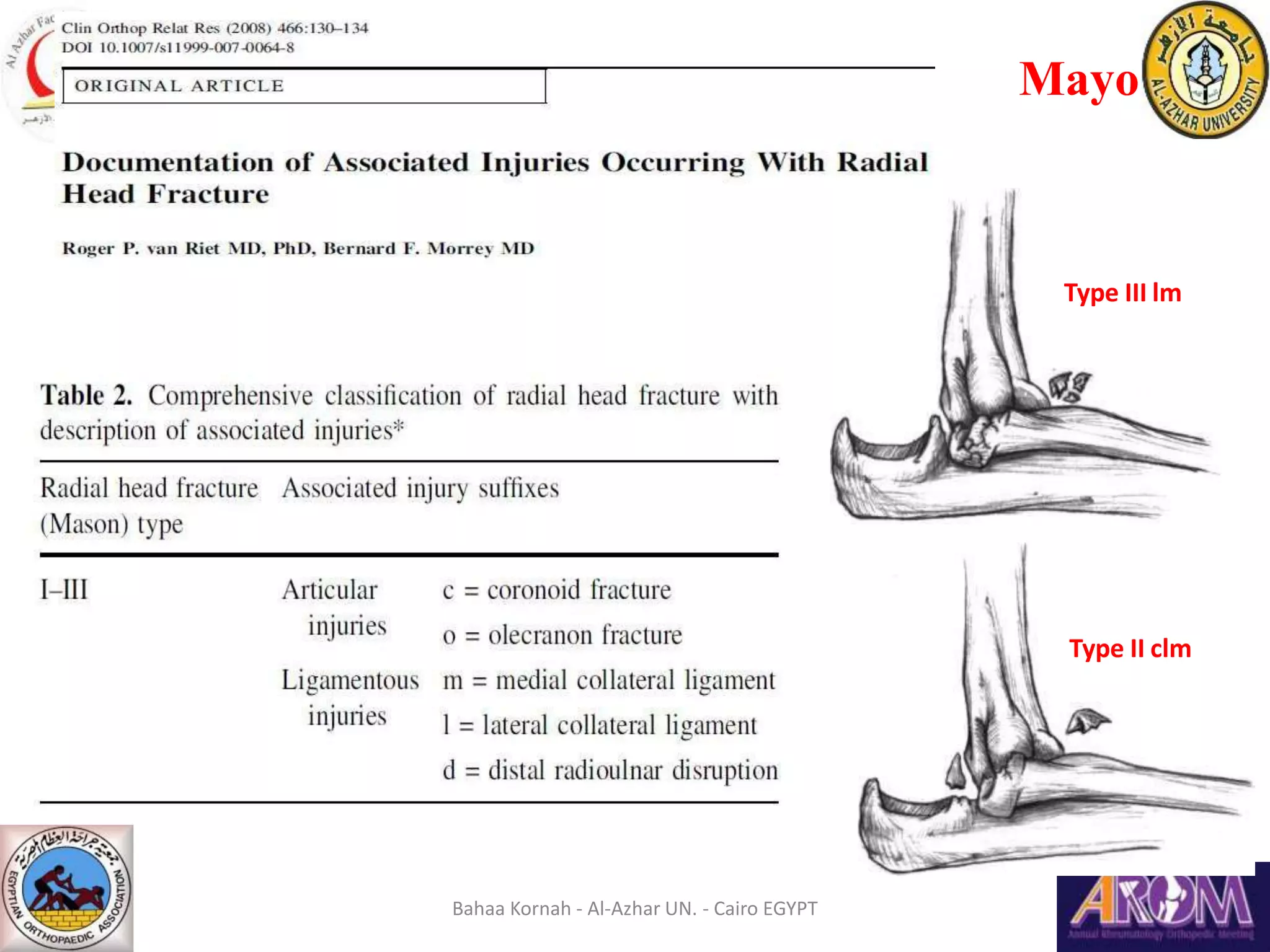 Radial Head Fracture Ppt