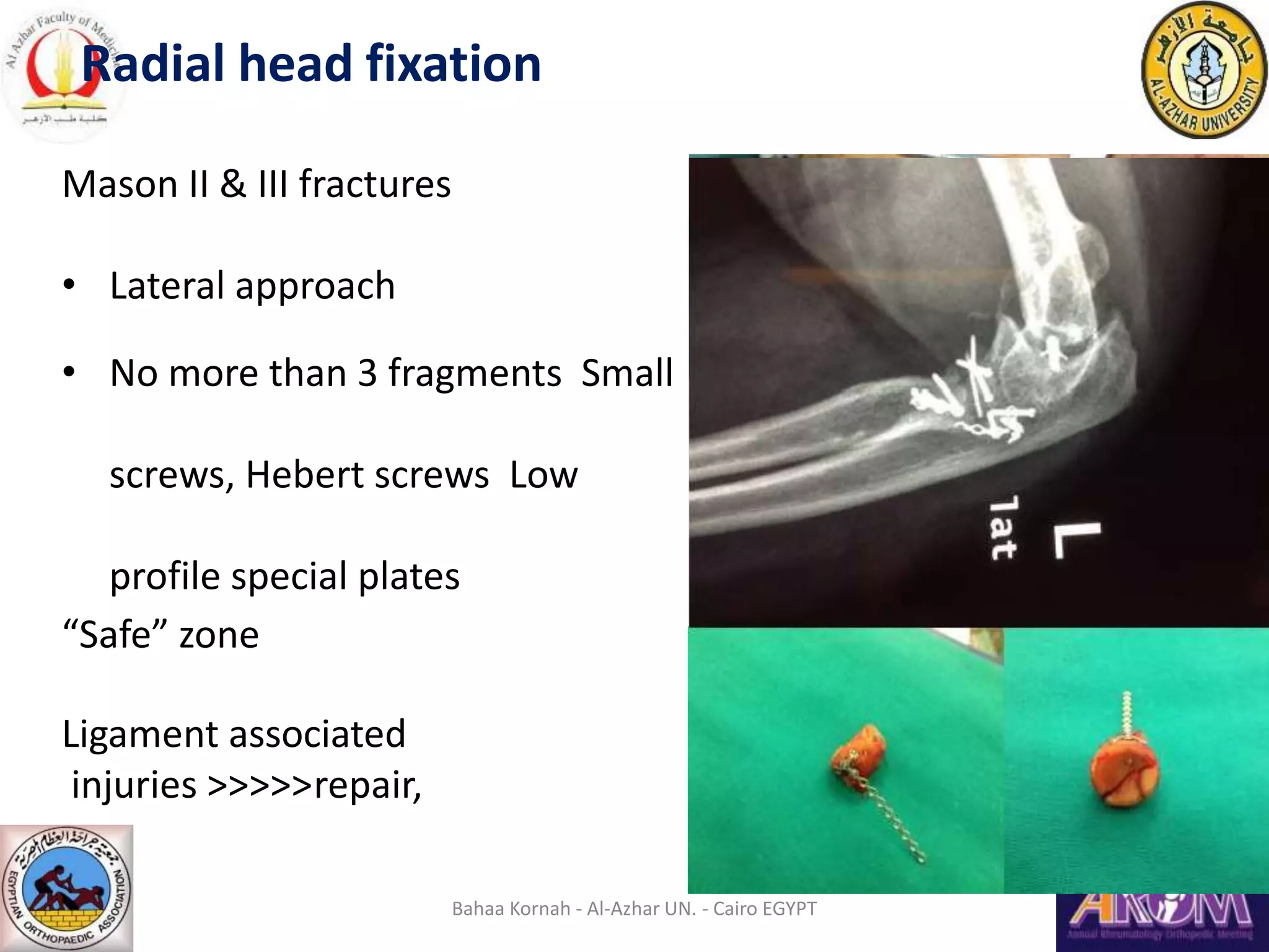 Radial head fracture | PPT