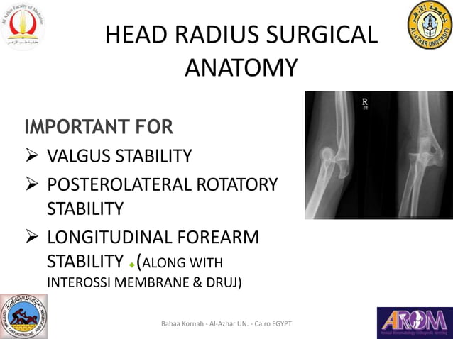 Radial head fracture | PPT | Death, Injury, or Military Conflict ...