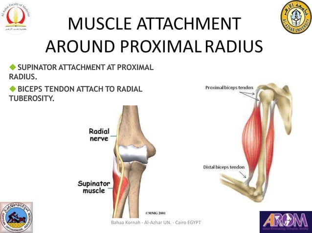 Radial head fracture | PPT | Death, Injury, or Military Conflict ...