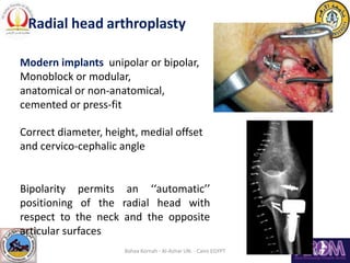 Radial head fracture | PPT