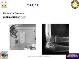 Radial head fracture | PPT