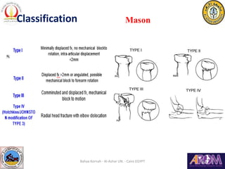 Radial head fracture | PPT