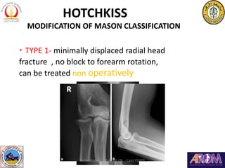 Radial head fracture | PPT