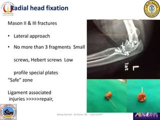Radial head fracture | PPT