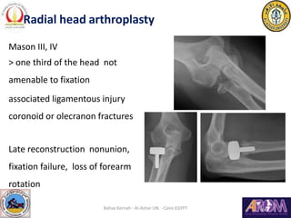 Radial head fracture | PPT