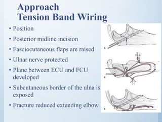 radial head fracture_and OLECRANONfracture.pptx