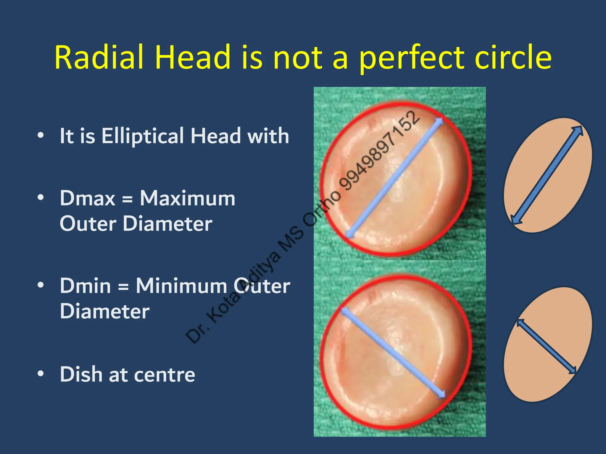 Radial Head Replacement - Surgical Tips and Tricks - Dr Kota Aditya | PDF