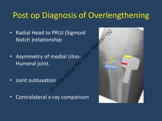 Radial Head Replacement - Surgical Tips and Tricks - Dr Kota Aditya | PDF