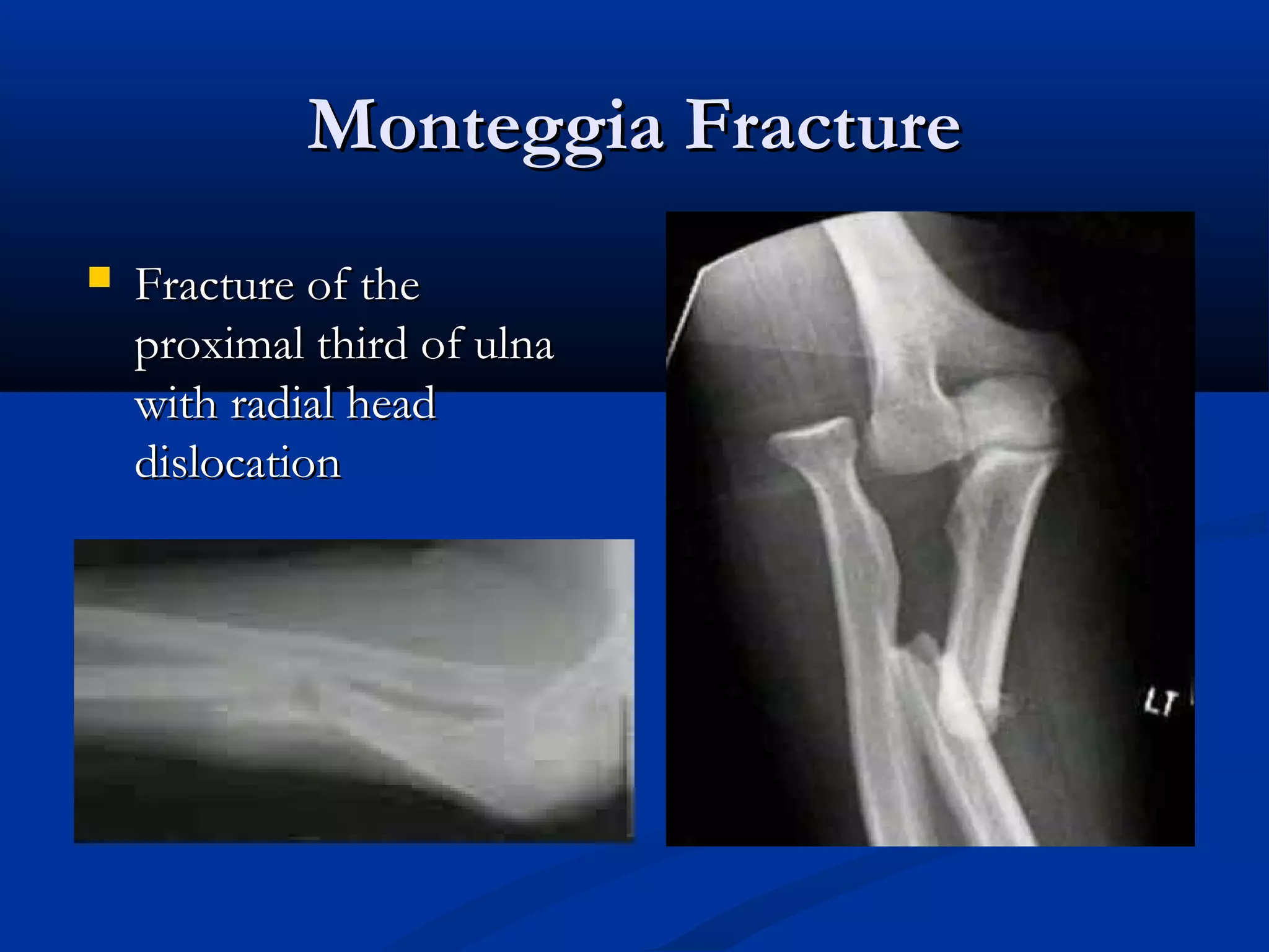 Radial head subluxation “nursemaids’ elbow” | PPT