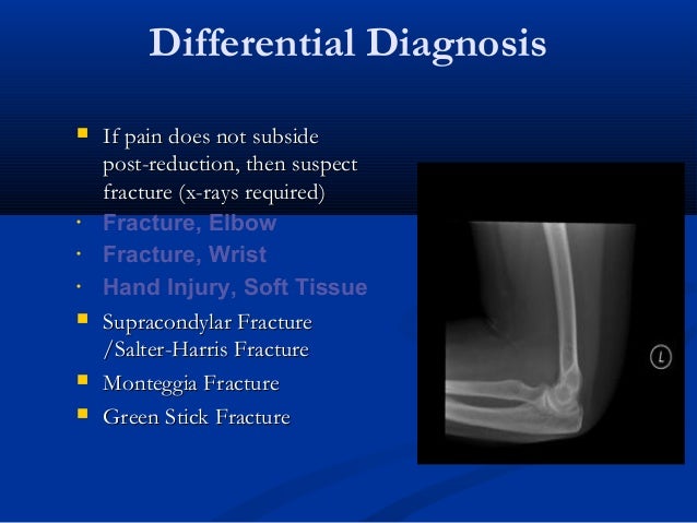 Radial head subluxation “nursemaids’ elbow”