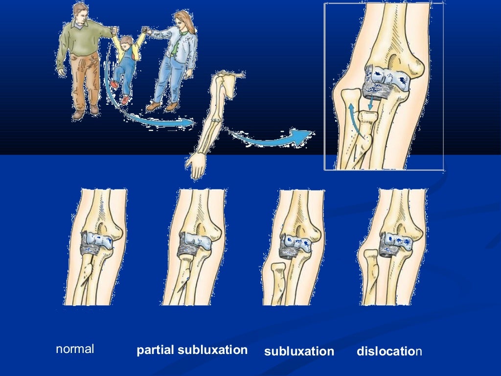 Pain After Nursemaid's Elbow at Karen Medina blog