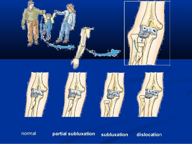 Radial head subluxation “nursemaids’ elbow”