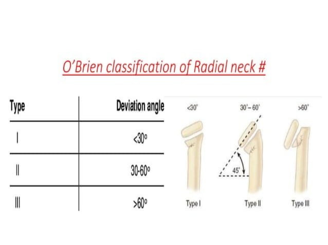 Radial_neck_factures[1].pptxgjhfgghhjjhfffff | PPT