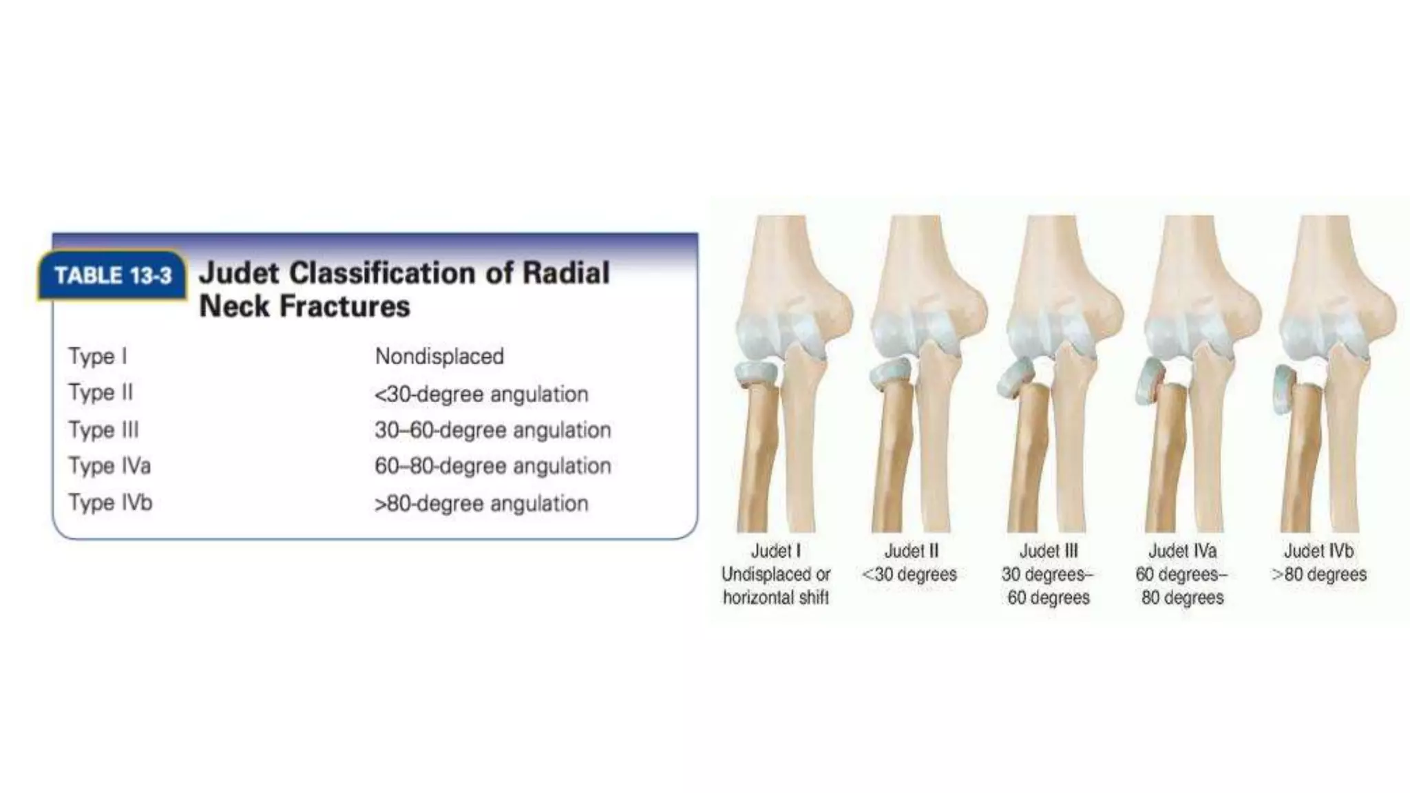 Radial neck fracture | PPTX