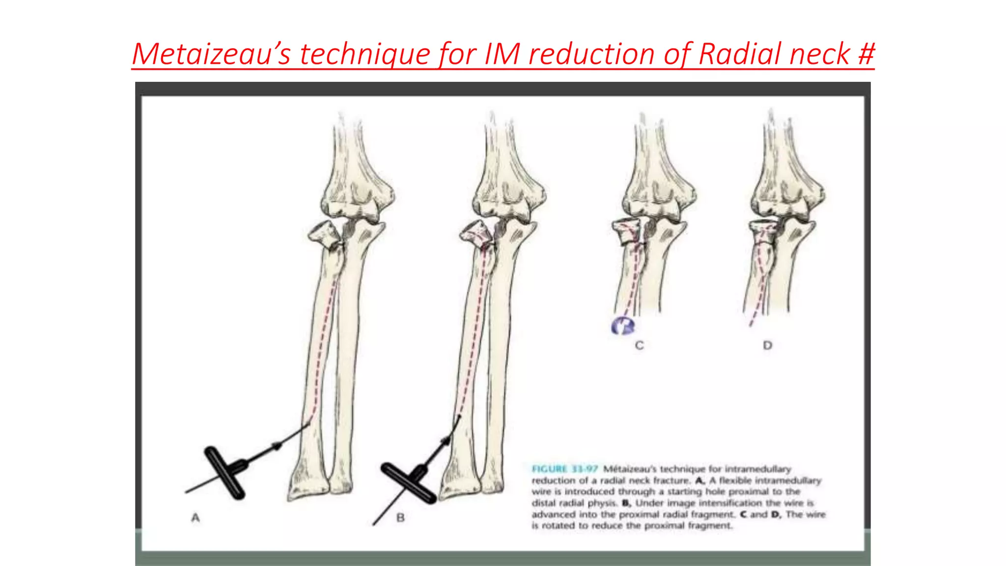 Radial neck fracture | PPTX