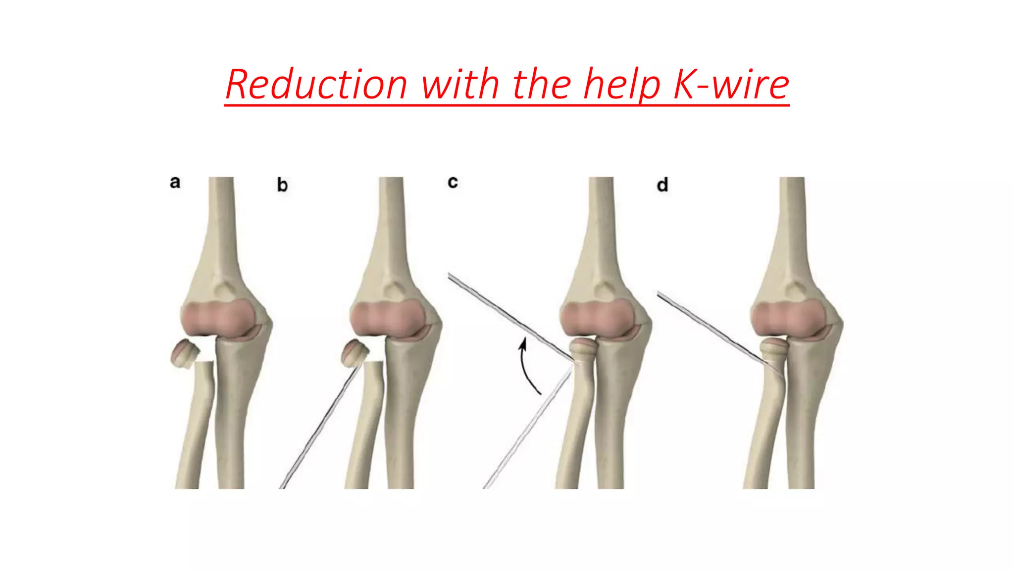 Radial neck fracture | PPTX