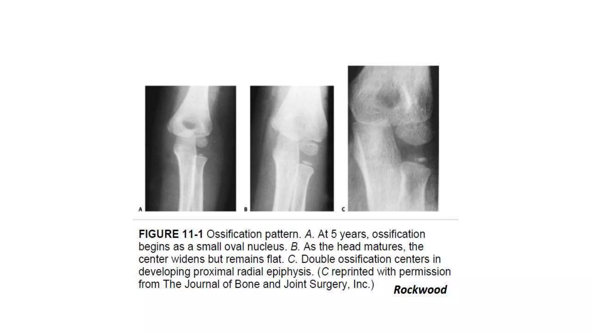 Radial neck fracture | PPTX