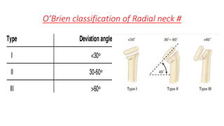 Radial neck fracture | PPTX