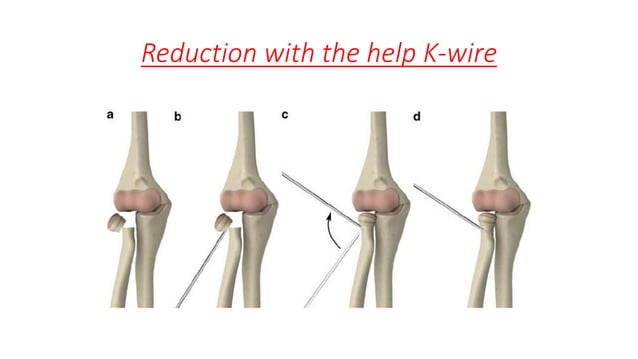 Radial neck fracture | PPTX