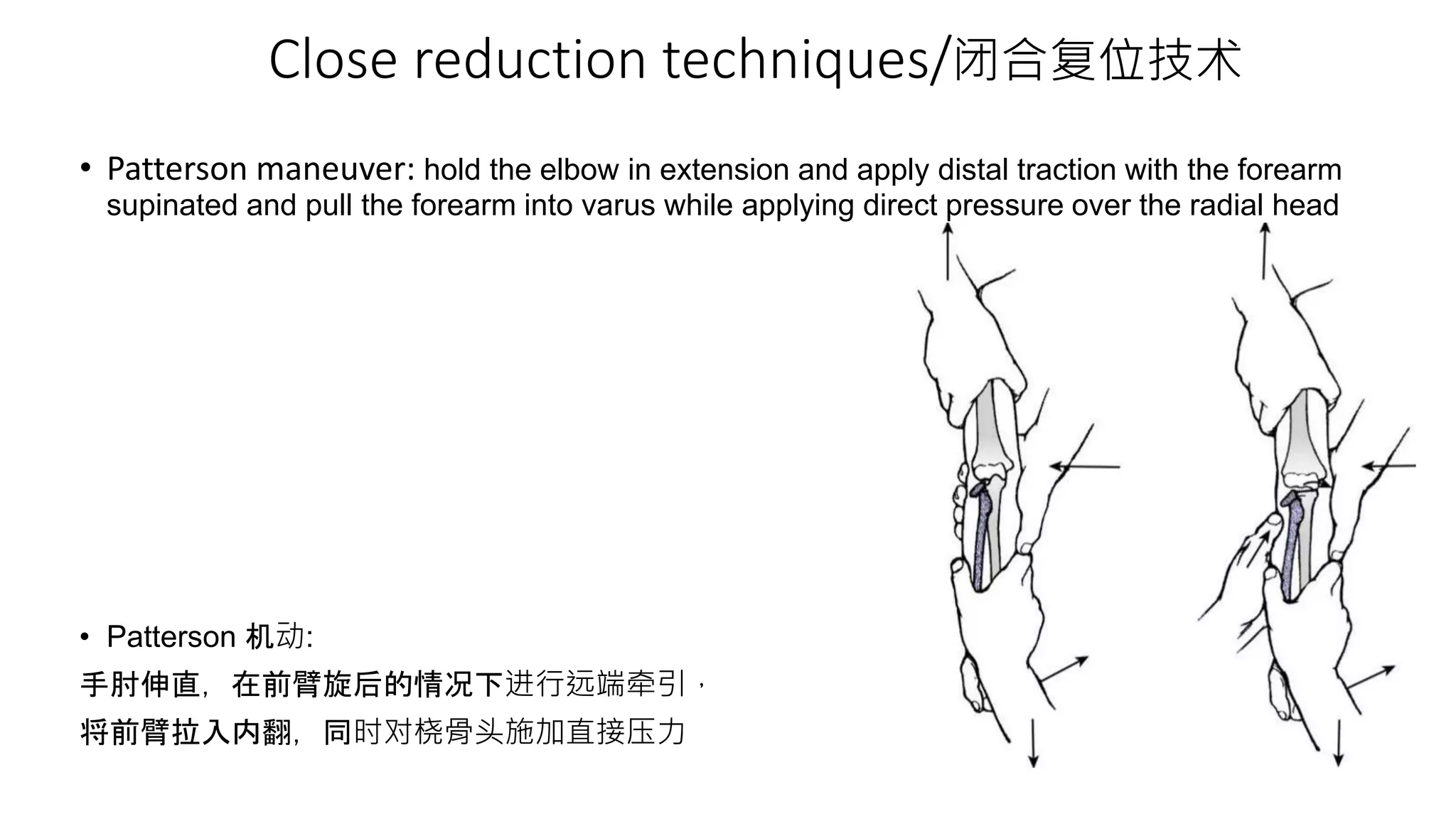 Radial neck fracture | PPTX