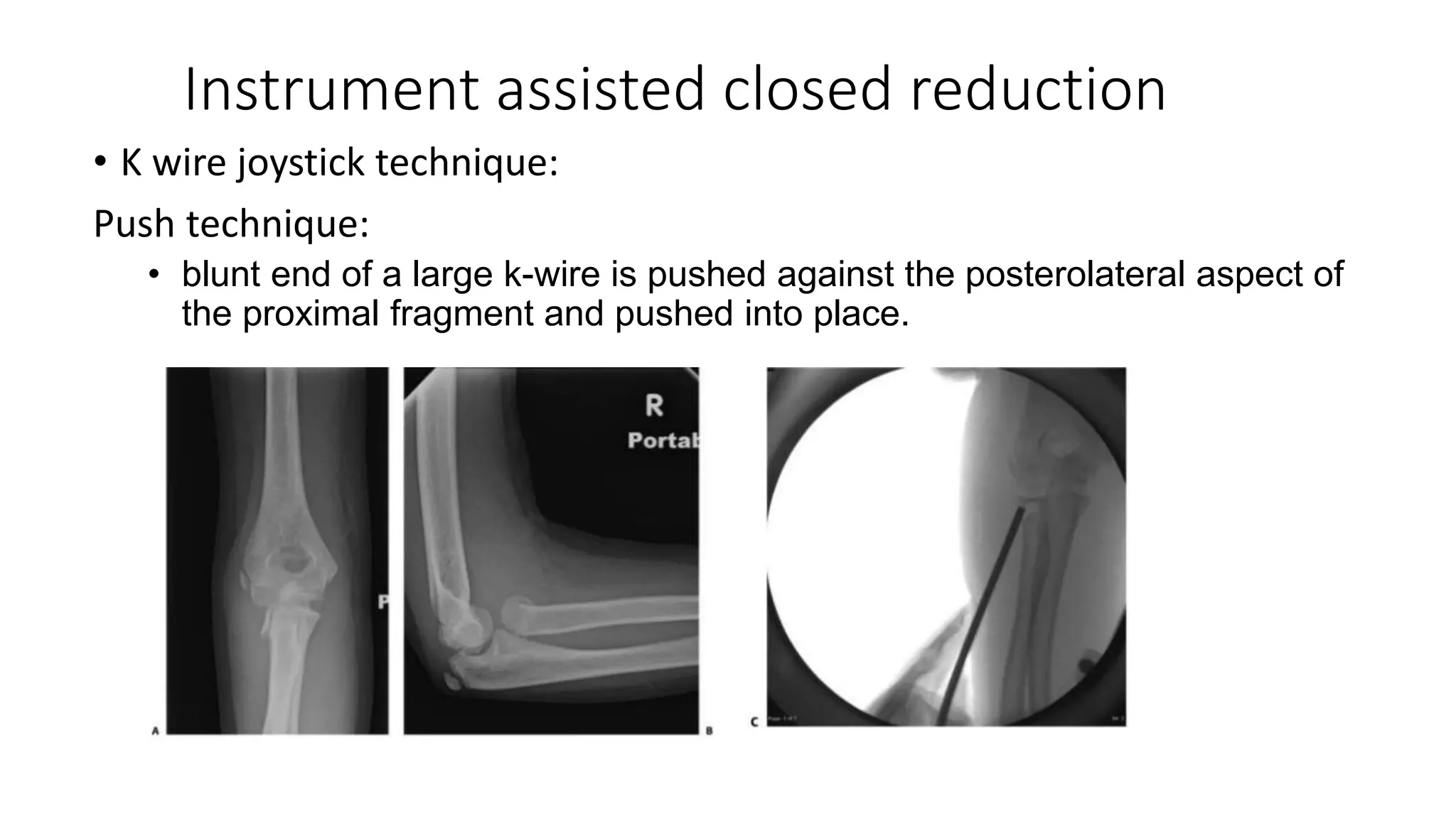 Radial neck fracture | PPTX