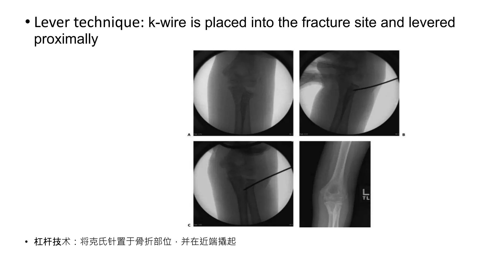 Radial neck fracture | PPTX