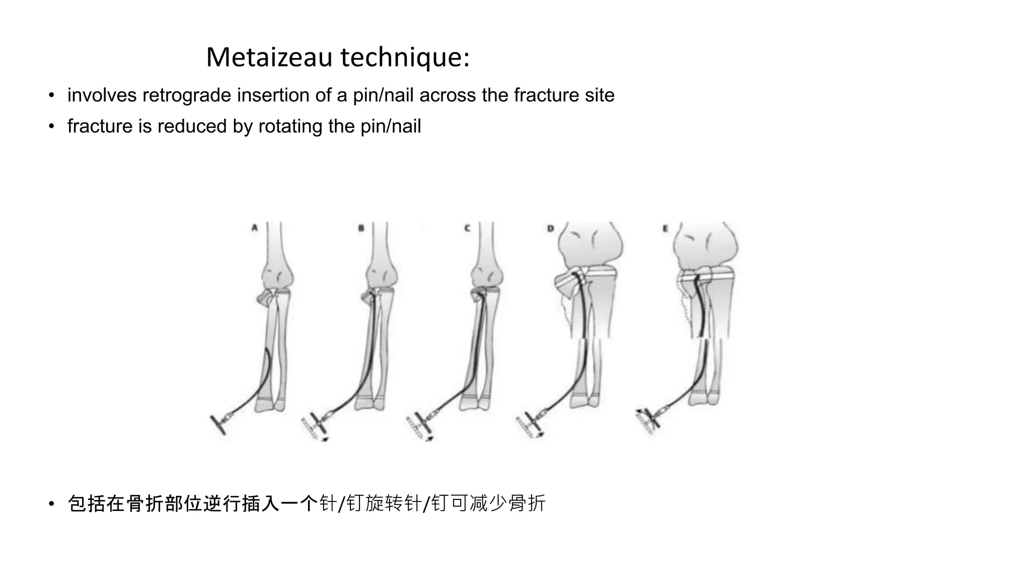 Radial neck fracture | PPTX