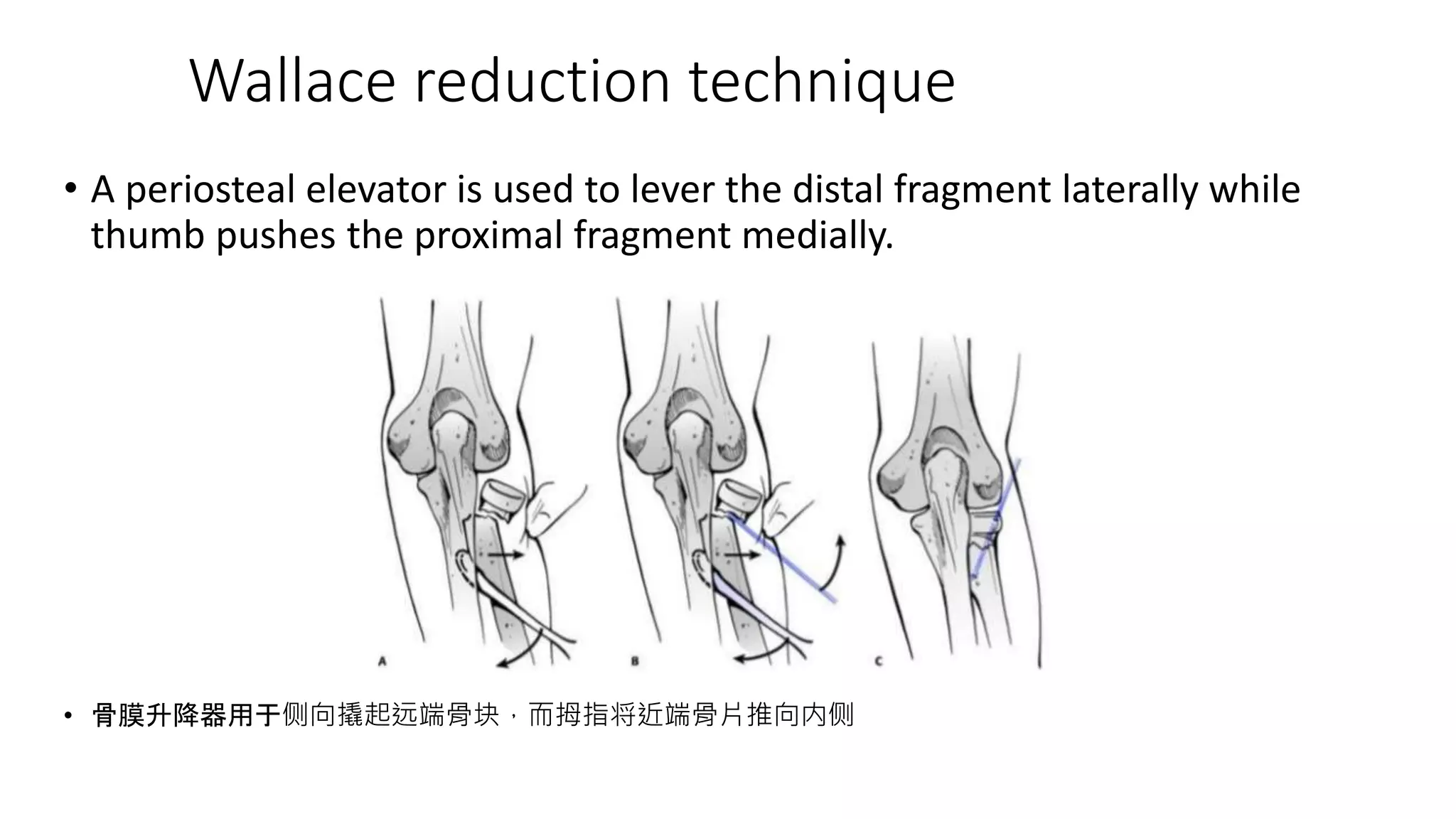 Radial neck fracture | PPTX