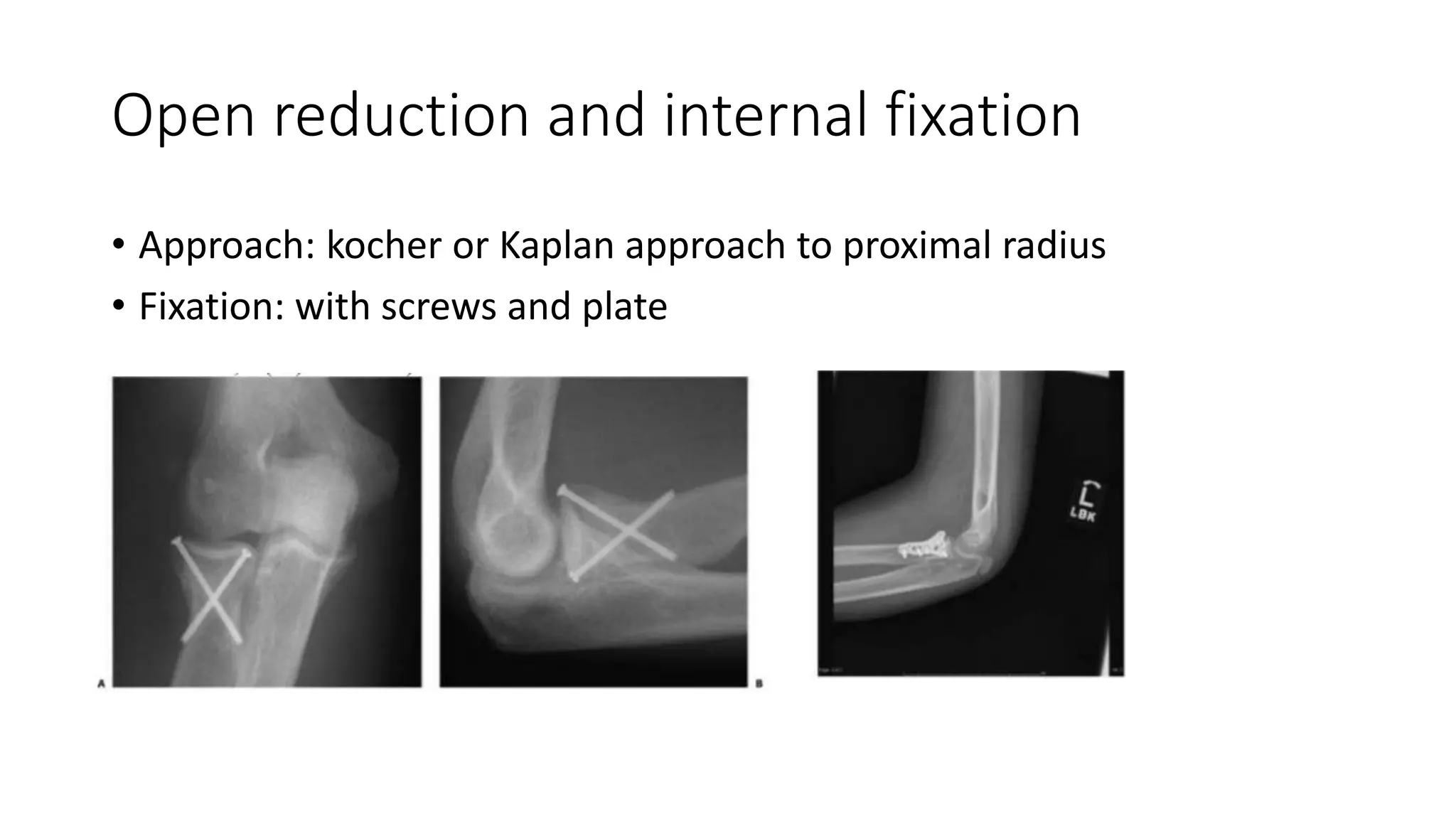 Radial neck fracture | PPTX