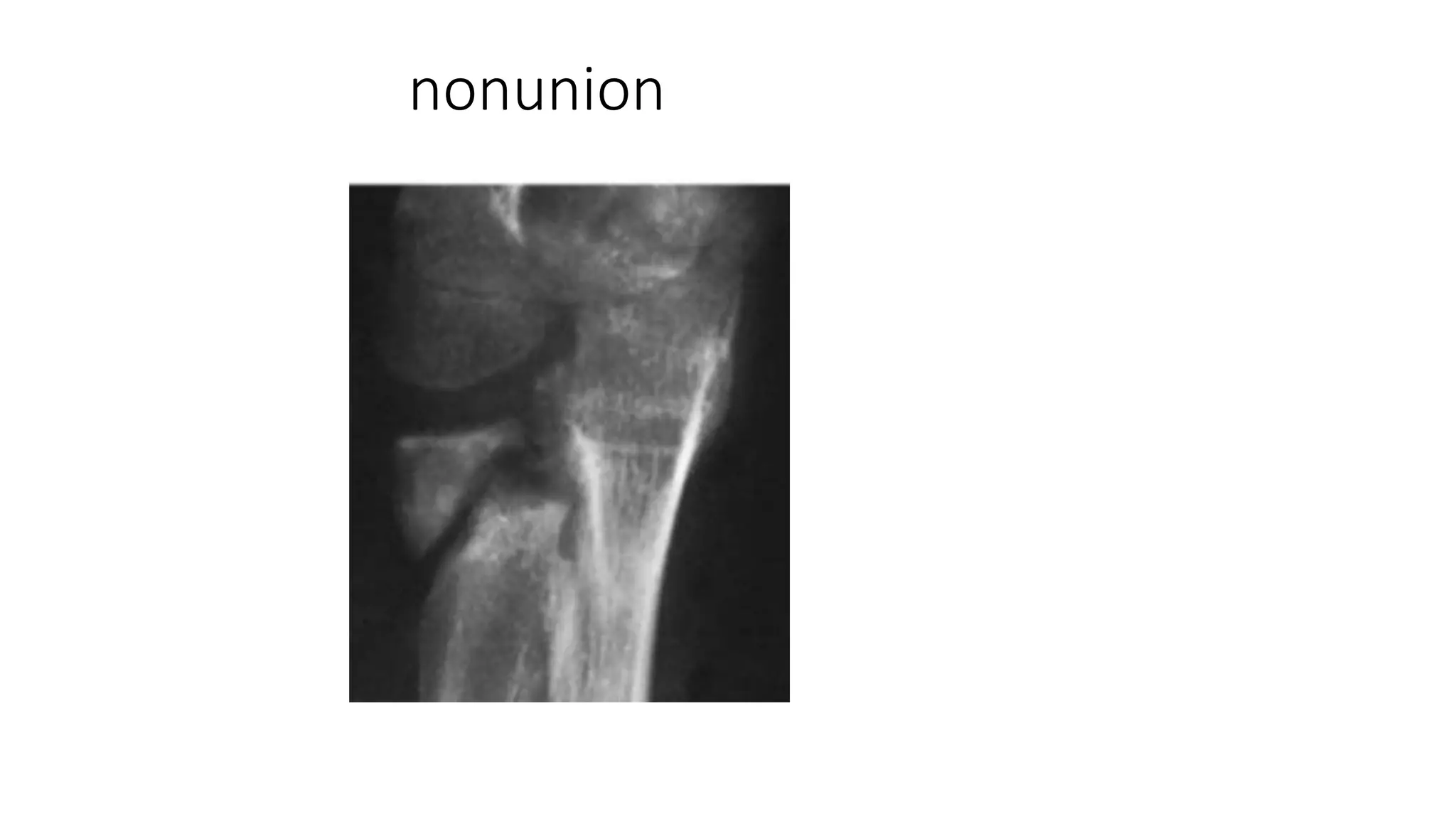 Radial neck fracture | PPTX